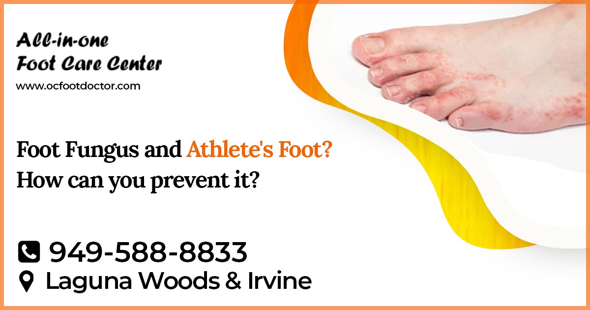 Foot Fungus and Athlete's Foot? How can you prevent it?