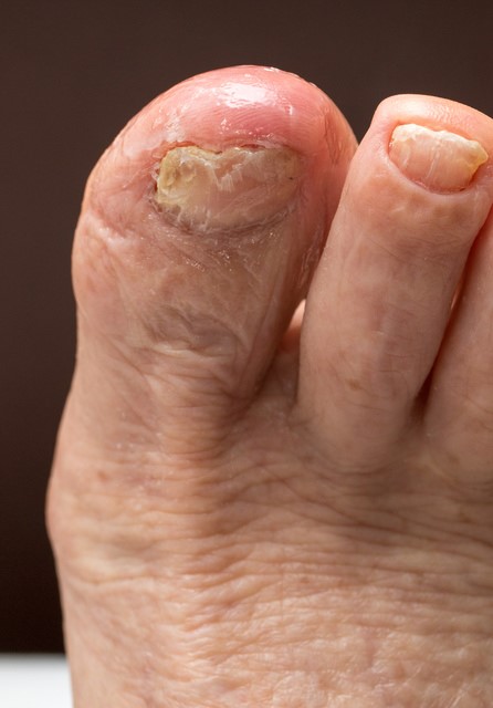 What to Look For When You Have Toenail Problems