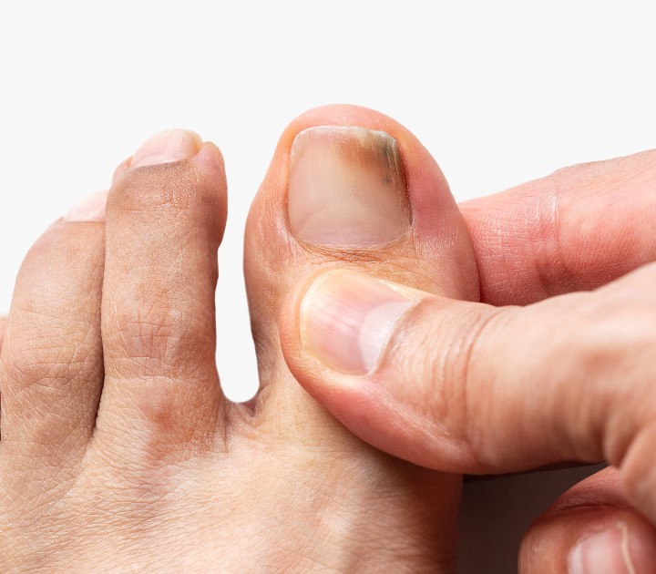 Nail Clues: What Your Toenails Reveal About Your Health