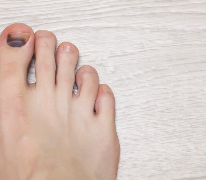Understanding & Treating Common Toenail Conditions