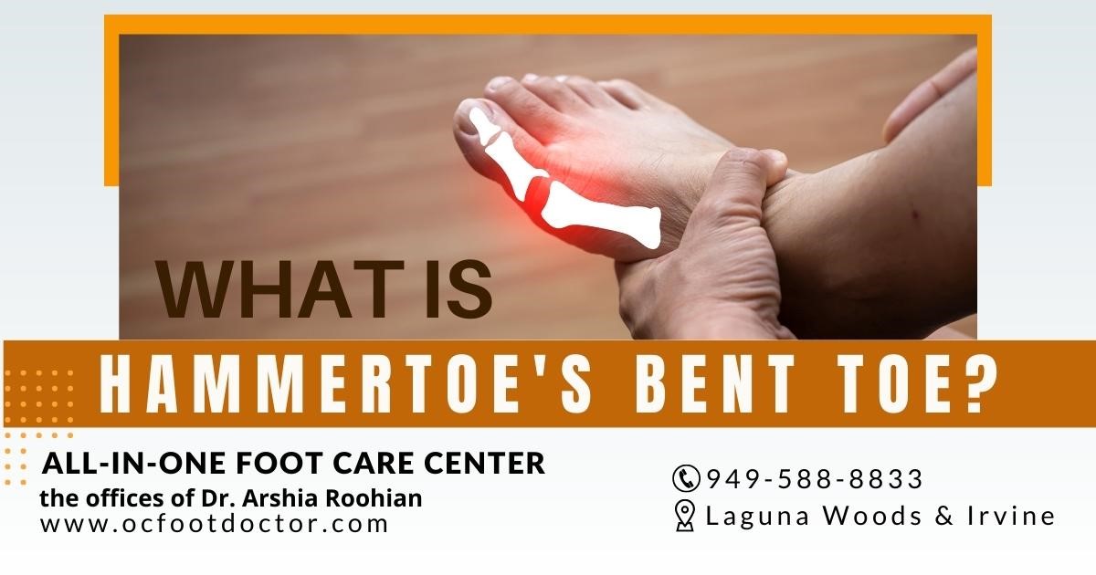 What is Hammertoe's Bent Toe?